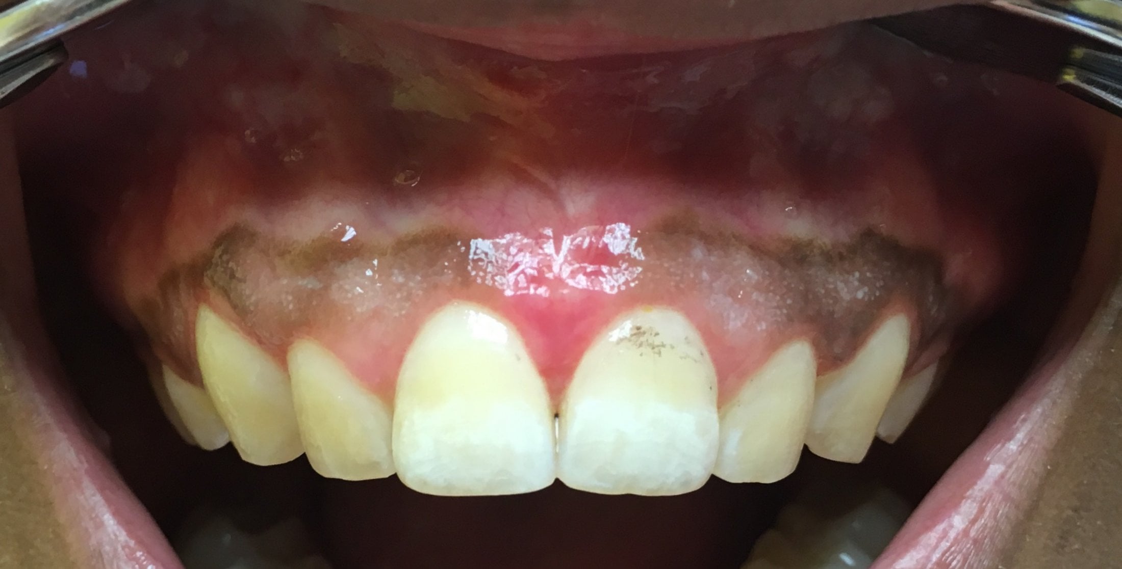 Gingival Depigmentation Chattanooga Gum Hyper Pigmentation Gingival Depigmentation Chattanooga Gum Hyper Pigmentation